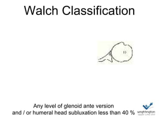 Pre op planning for shoulder arthroplasty | PPTX