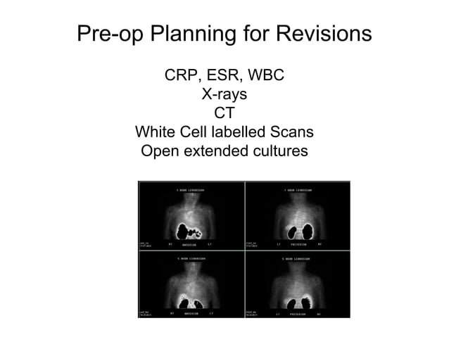 Pre op planning for shoulder arthroplasty | PPTX