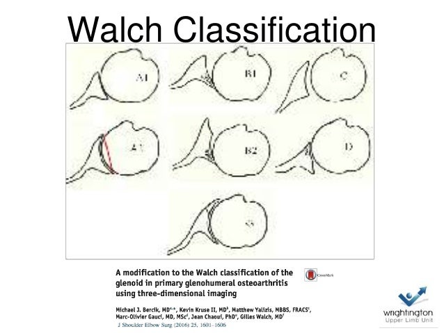 Pre op planning for shoulder arthroplasty