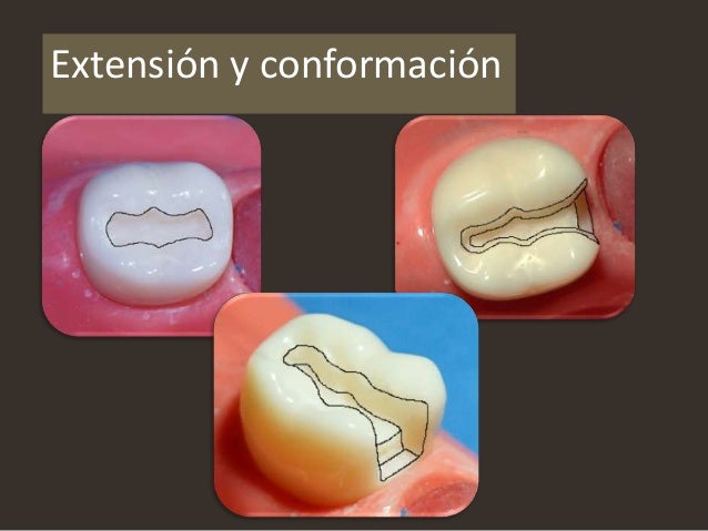 Preparación biológica para inlay 3.7