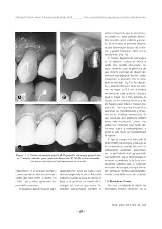 Preparacion de carillas de porcelana | PDF