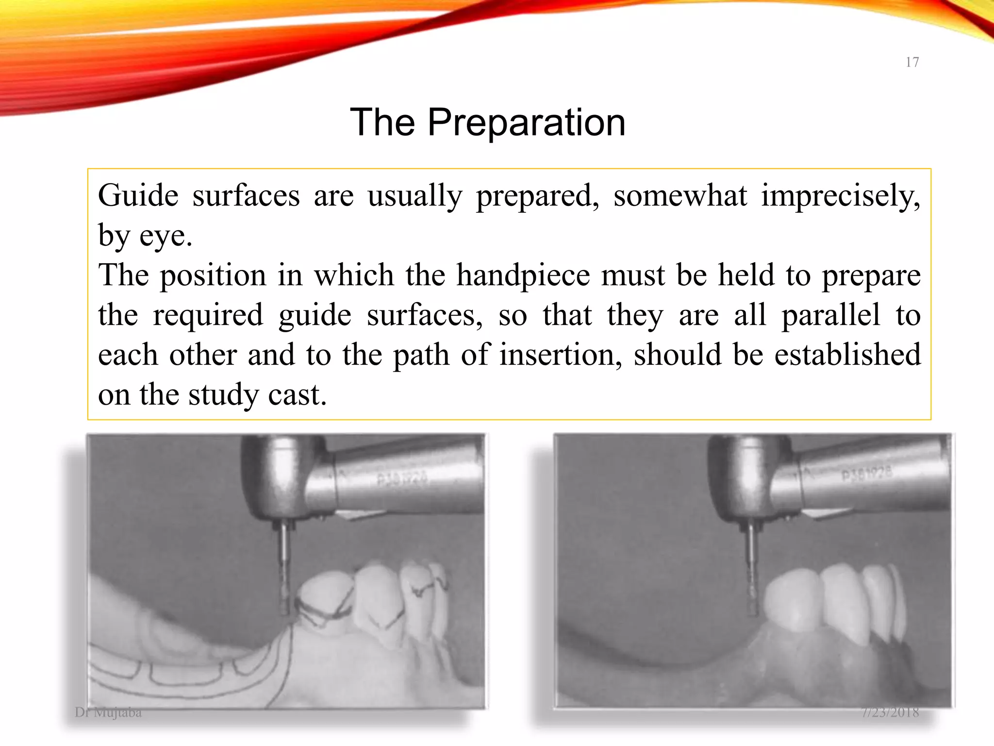 Preparation of abutment teeth | PPTX