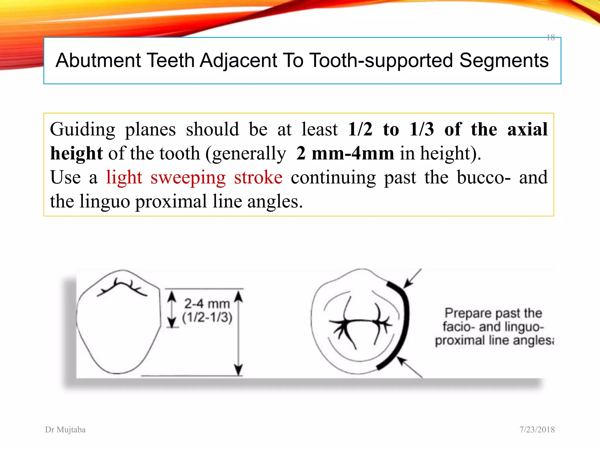 Preparation of abutment teeth | PPTX