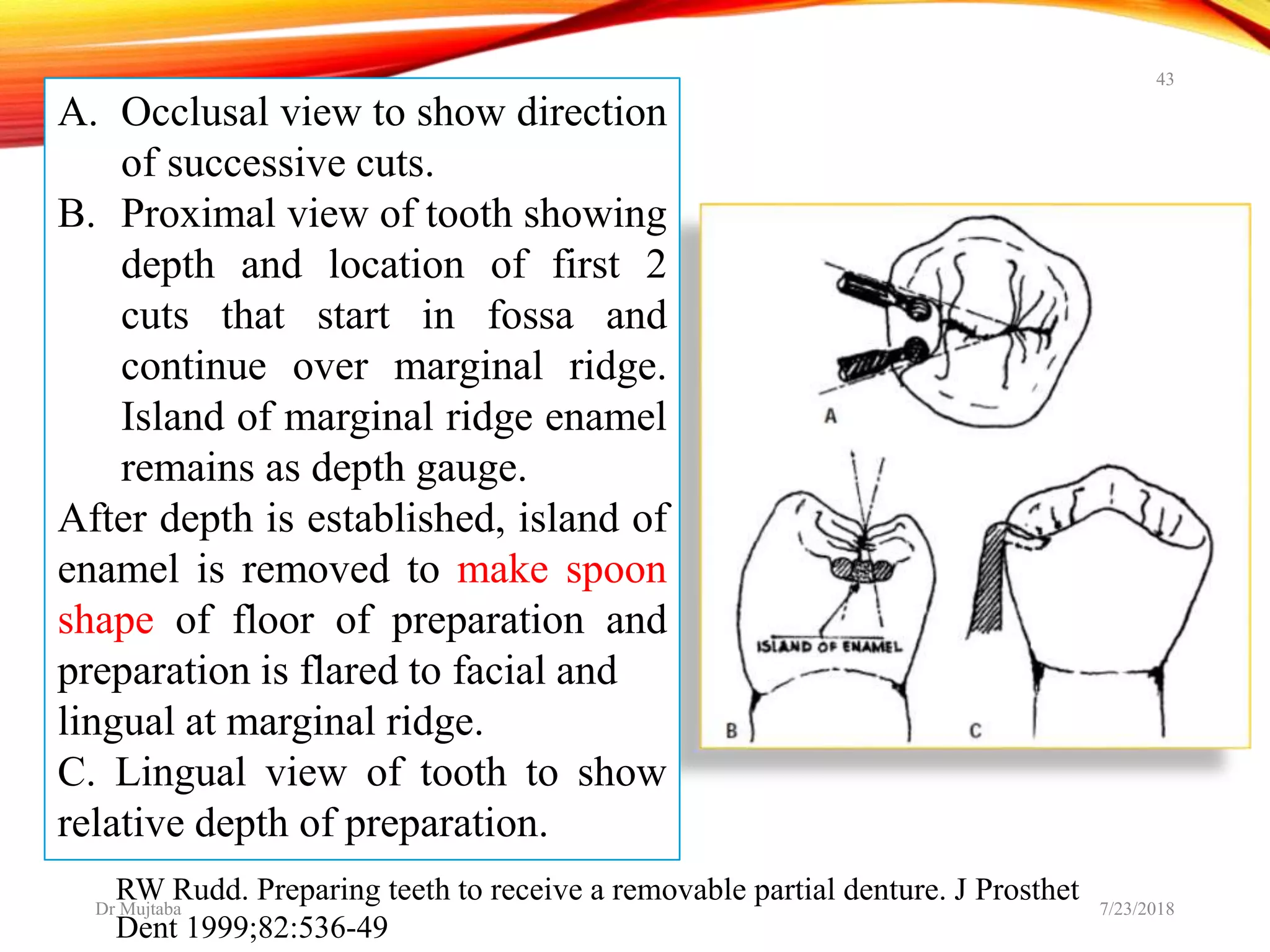 Preparation of abutment teeth | PPTX