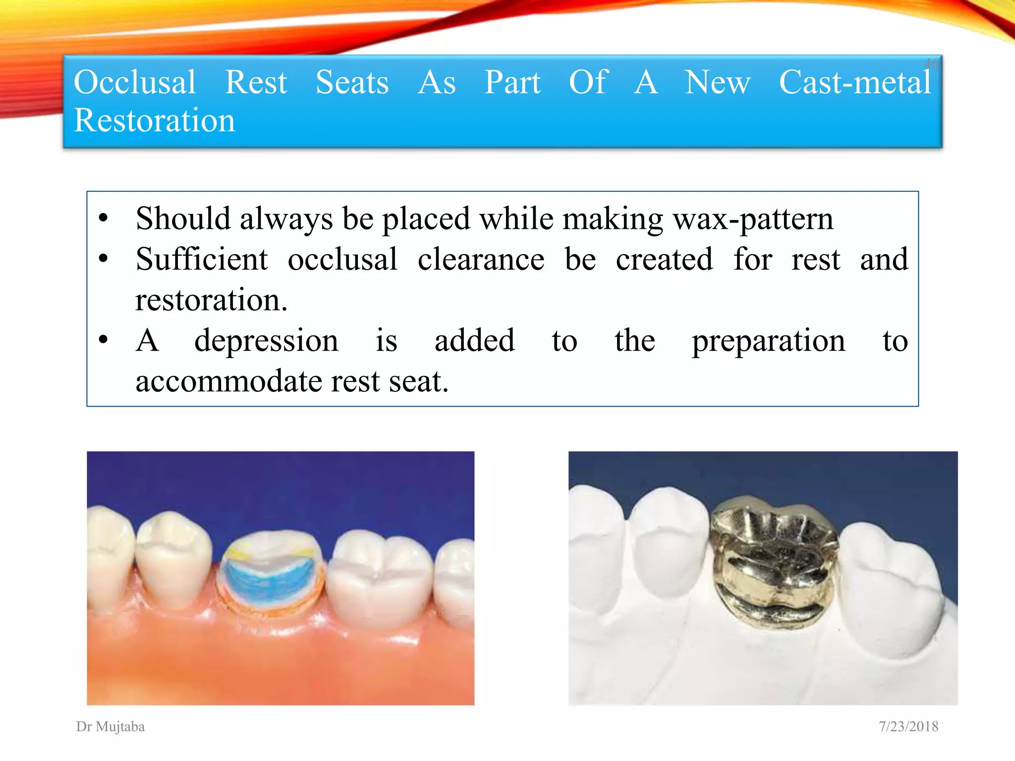 Preparation of abutment teeth | PPTX