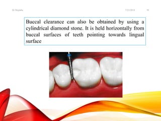 Preparation of abutment teeth | PPTX