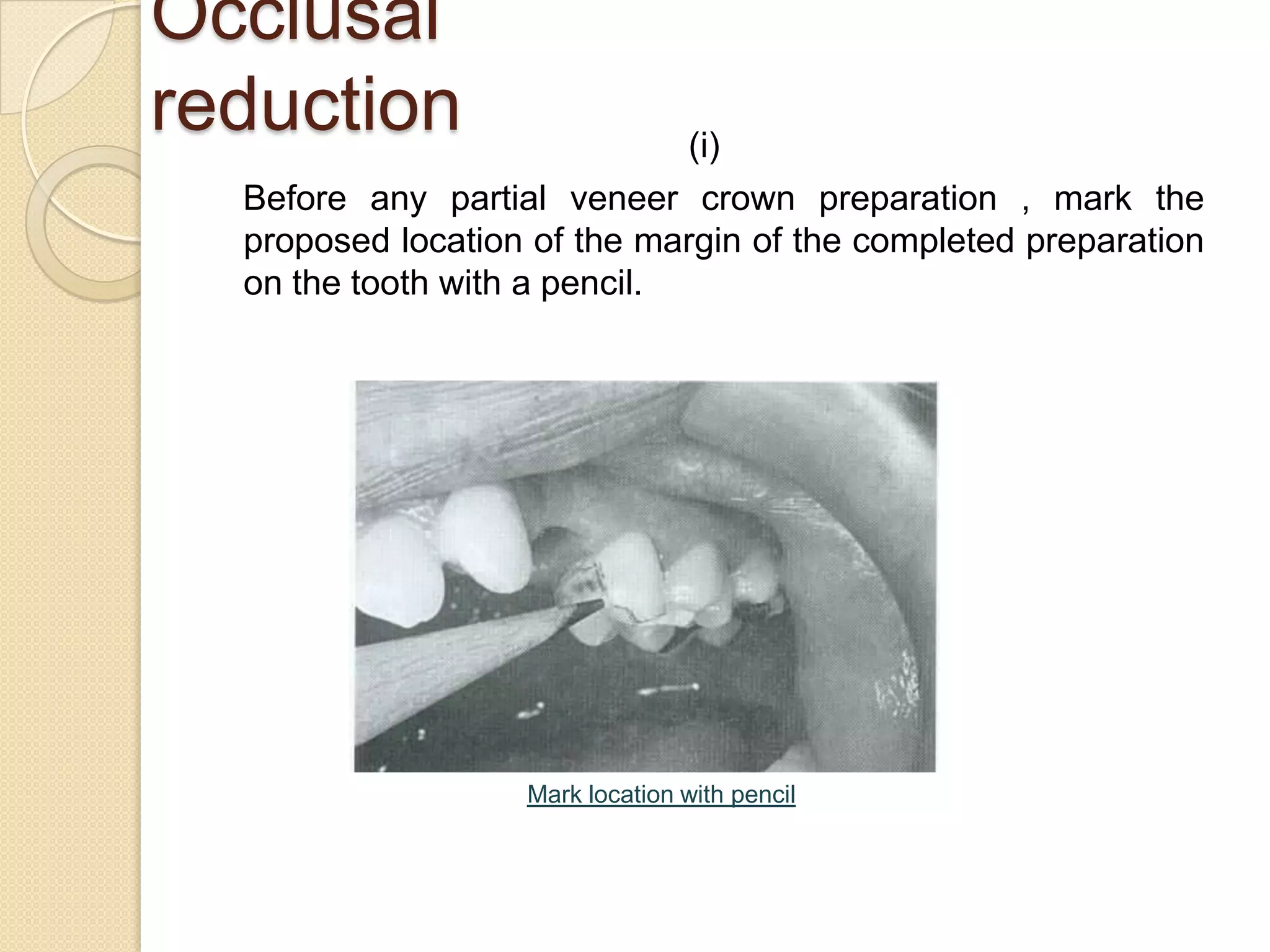 Preparation of partial veneer crown | PPTX