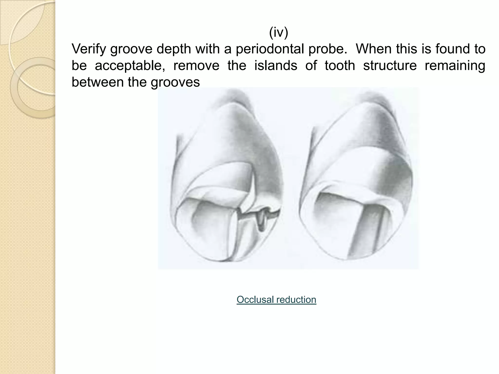Preparation of partial veneer crown | PPTX