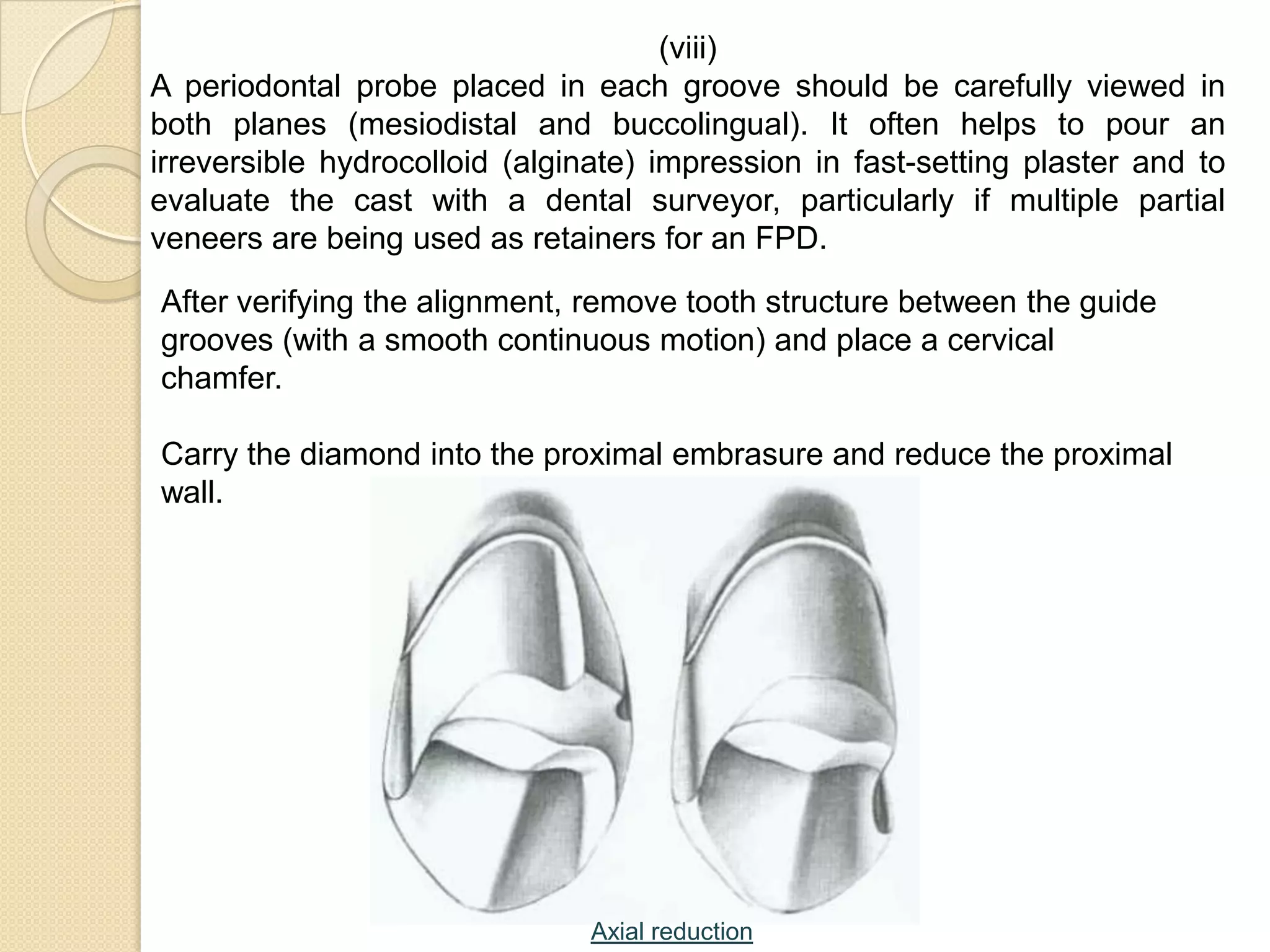 Preparation of partial veneer crown | PPTX