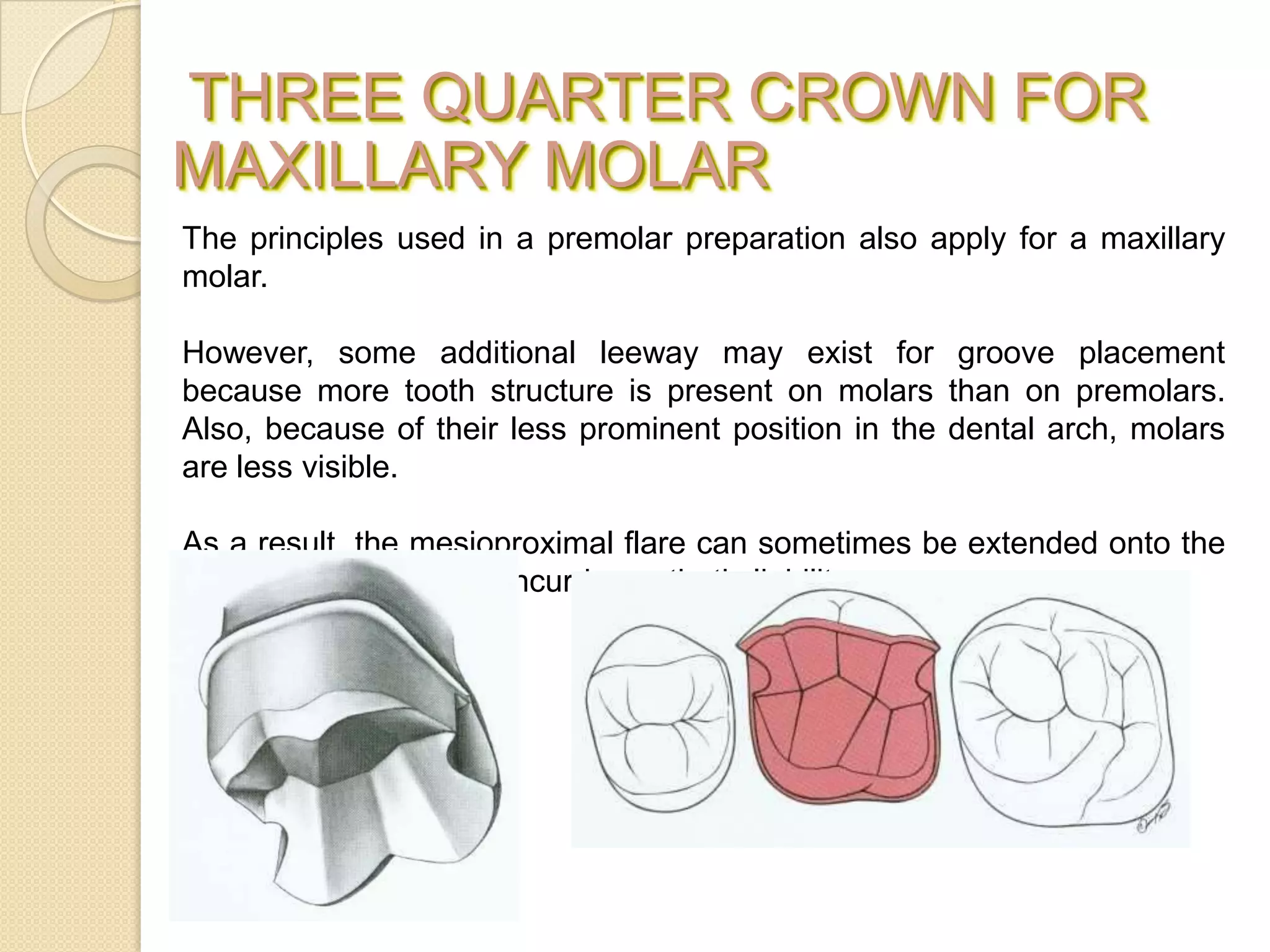 Preparation of partial veneer crown | PPTX