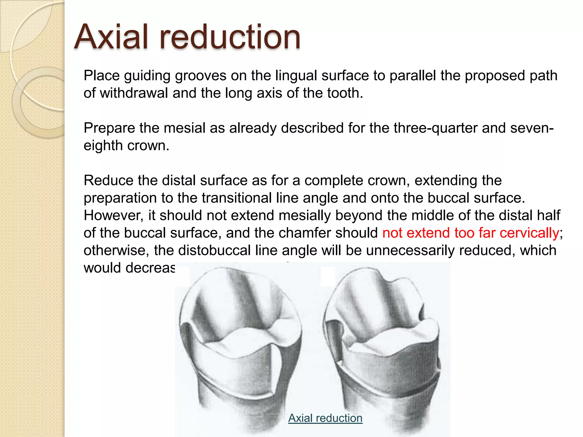 Preparation of partial veneer crown | PPTX