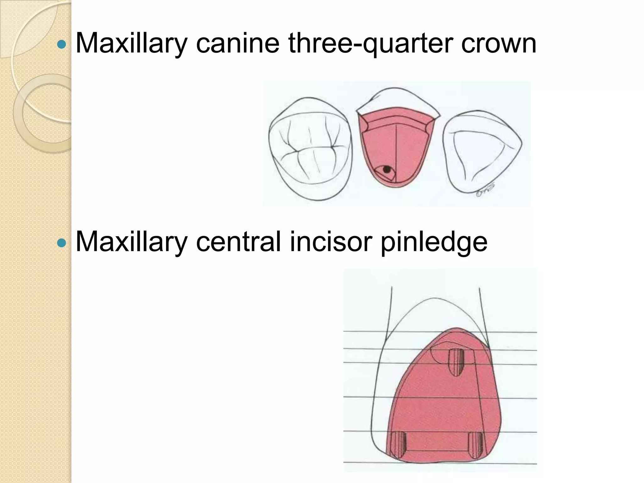 Preparation of partial veneer crown | PPTX