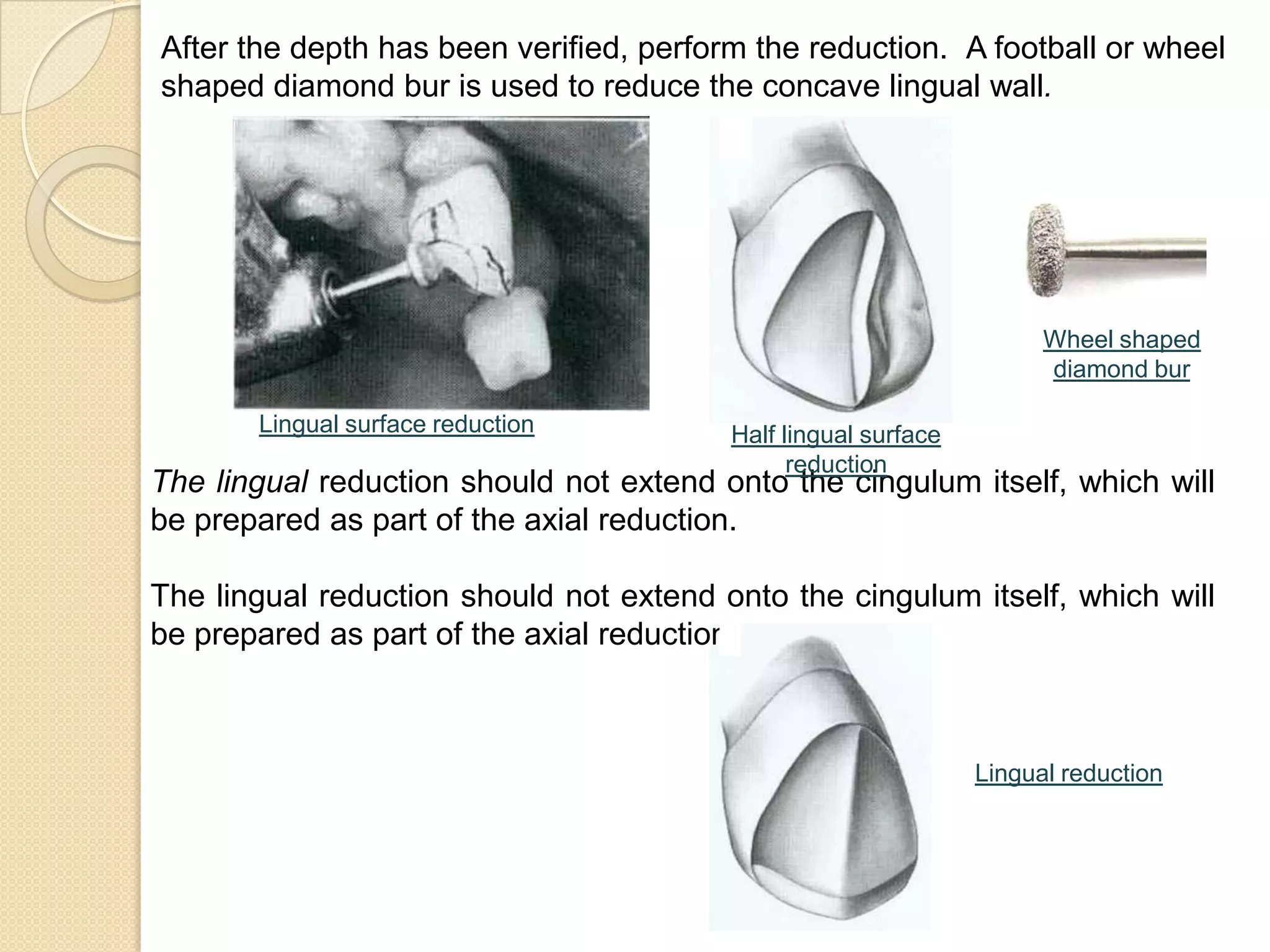 Preparation of partial veneer crown | PPTX