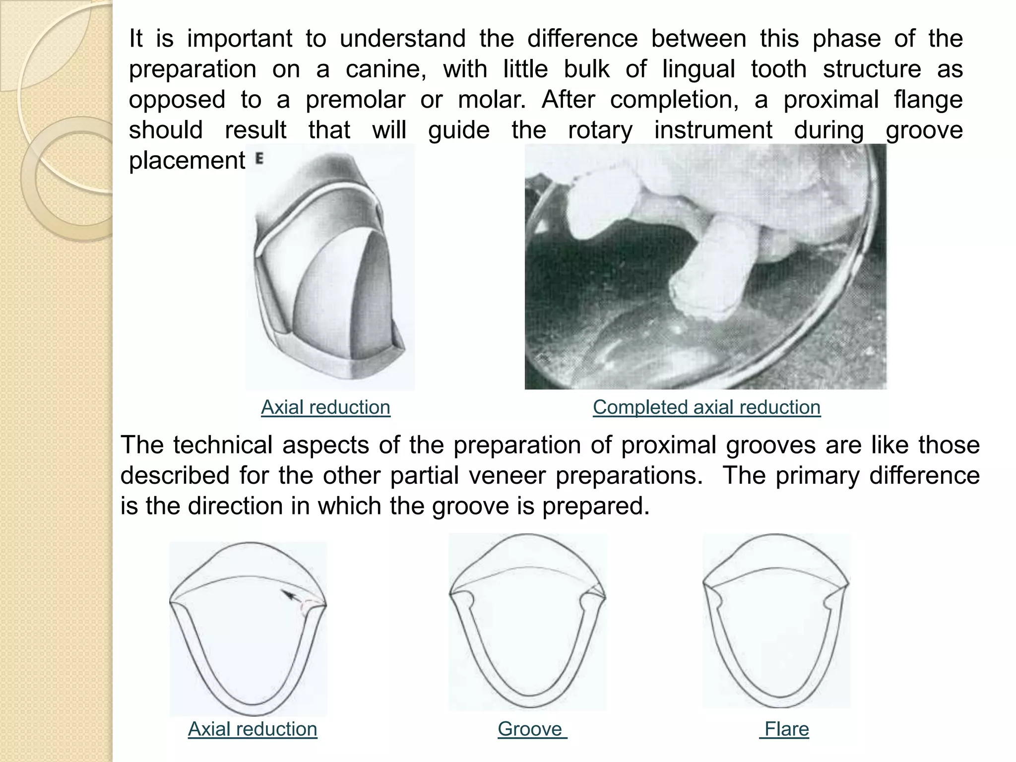 Preparation of partial veneer crown | PPTX
