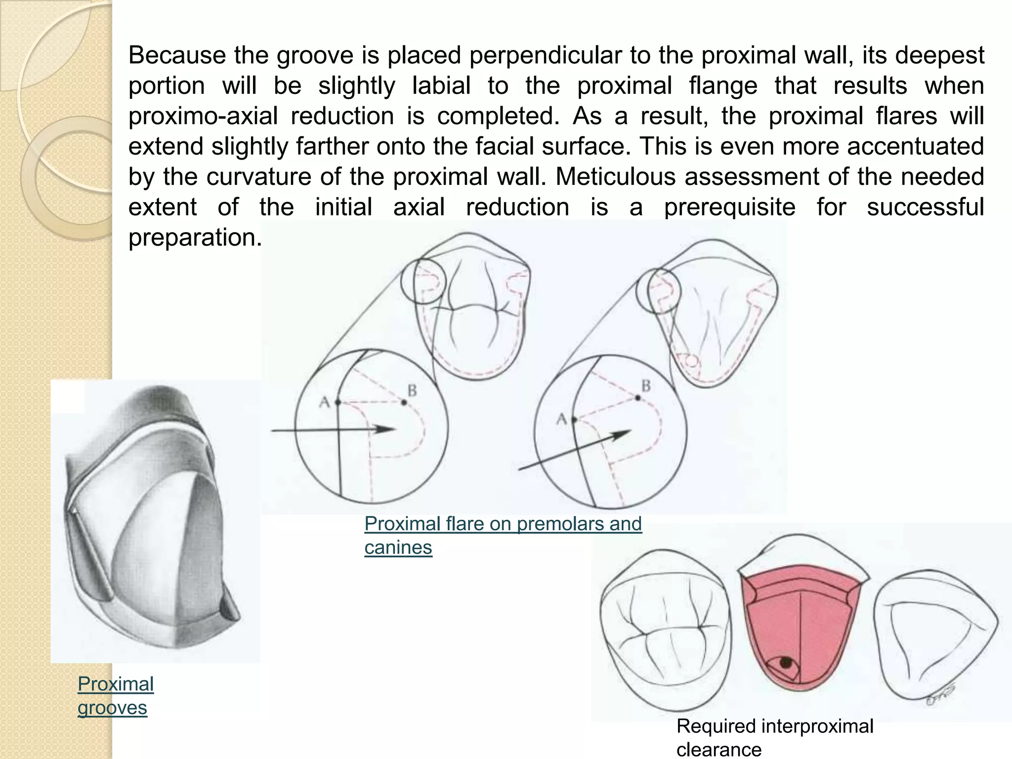 Preparation of partial veneer crown | PPTX