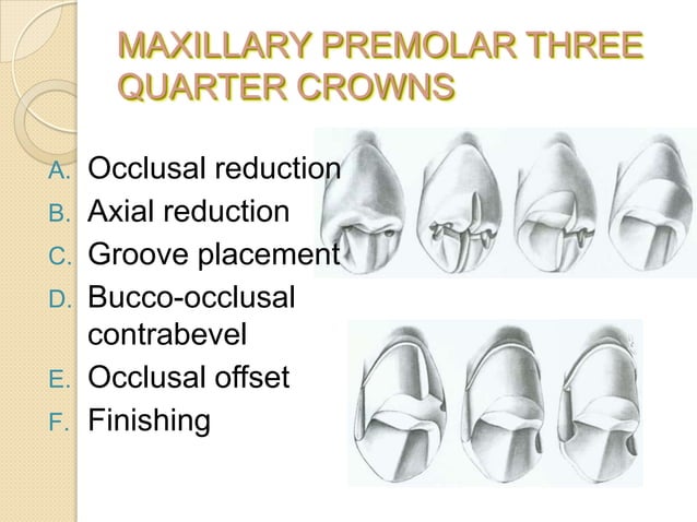 Preparation of partial veneer crown | PPTX | Dental Health | Diseases ...