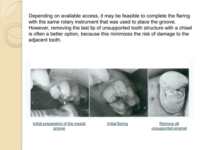 Preparation of partial veneer crown | PPTX | Dental Health | Diseases ...