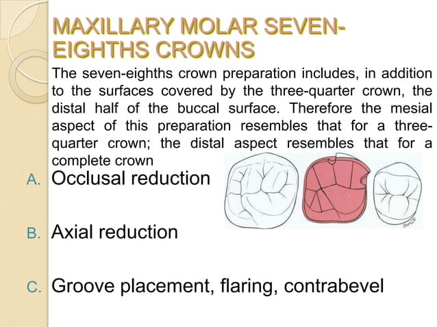 Preparation of partial veneer crown | PPT