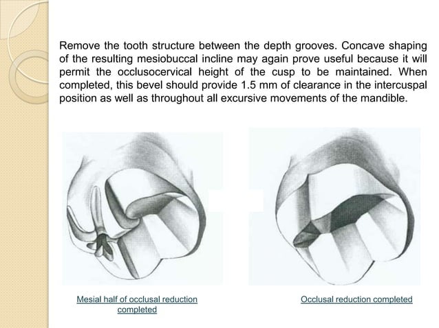 Preparation of partial veneer crown | PPTX | Dental Health | Diseases ...