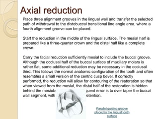 Preparation of partial veneer crown | PPTX