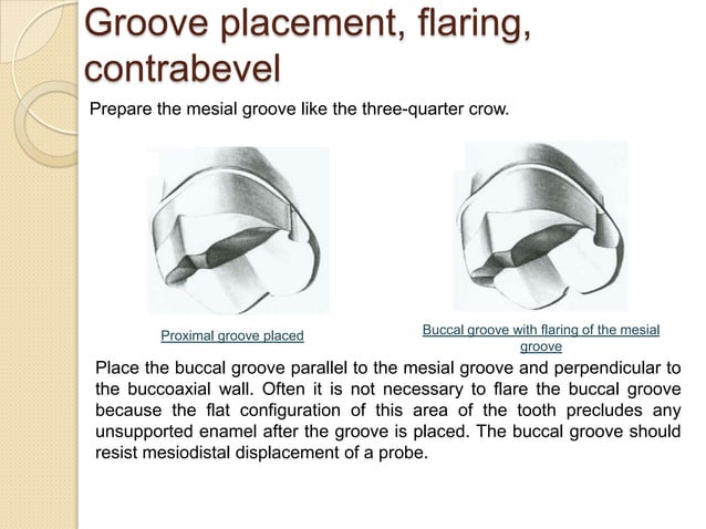 Preparation of partial veneer crown | PPTX | Dental Health | Diseases ...