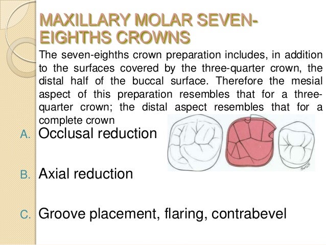 Preparation of partial veneer crown