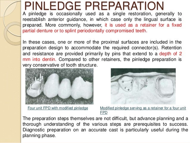 Preparation of partial veneer crown