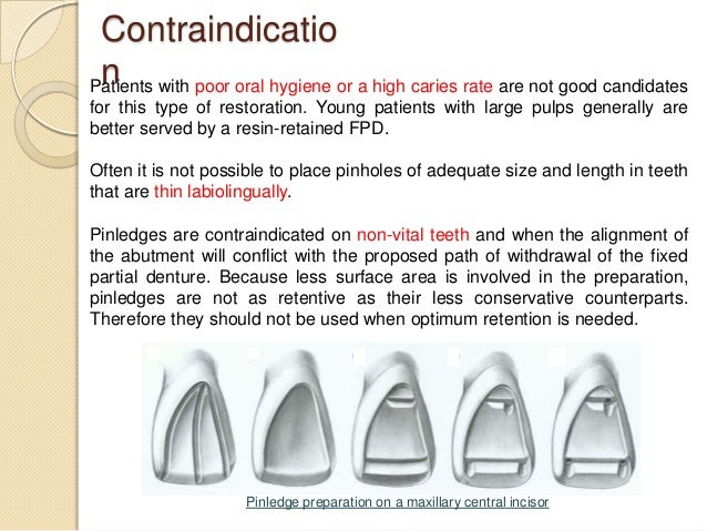 Preparation of partial veneer crown