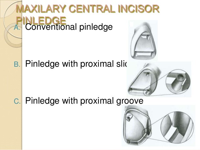 Preparation of partial veneer crown