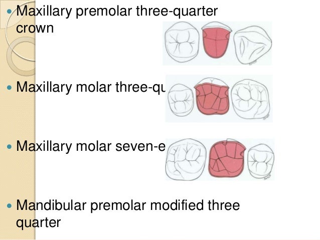 Preparation of partial veneer crown