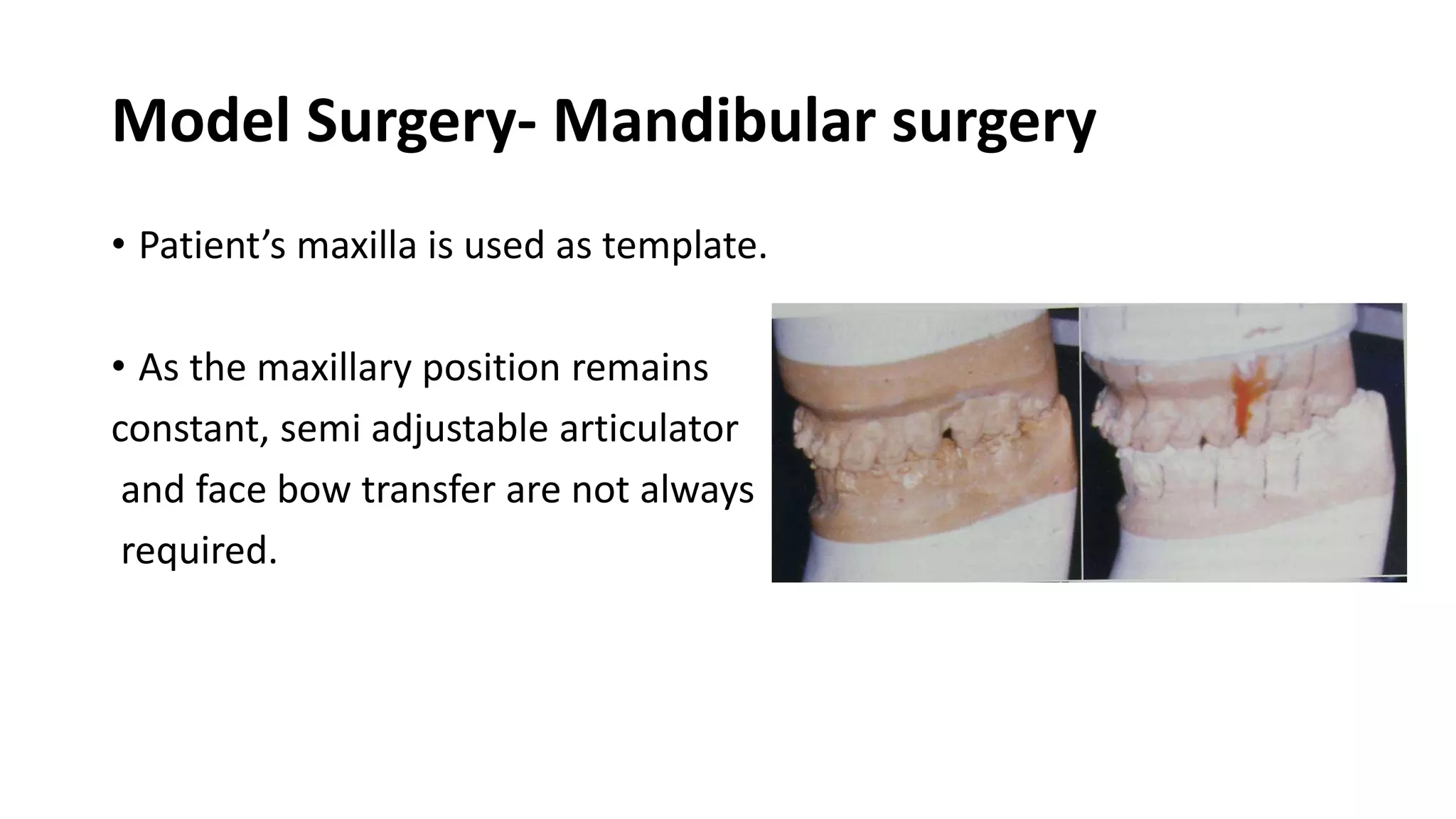 Preparation of surgical splints in bi jaw surgery | PPTX