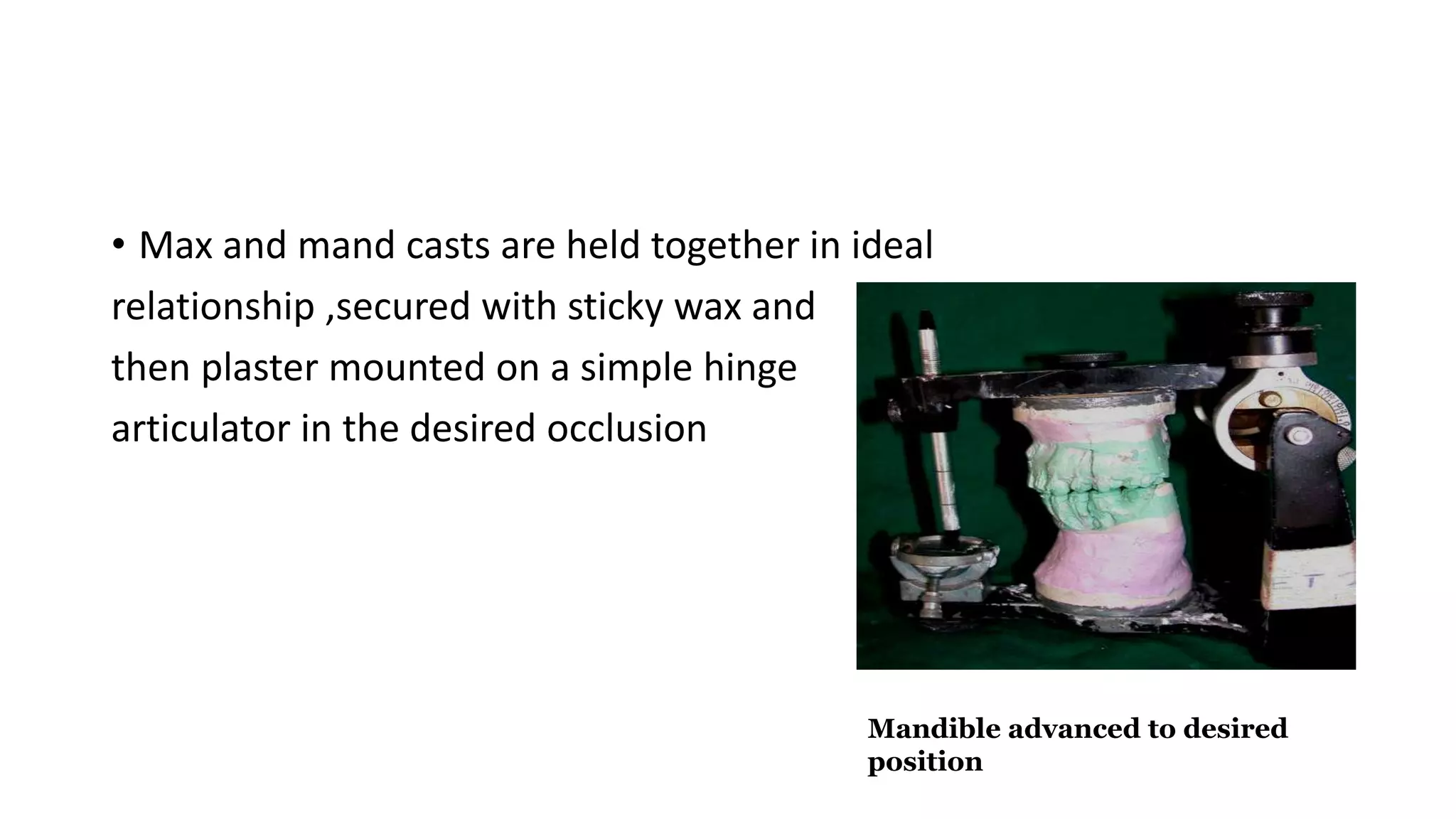 Preparation of surgical splints in bi jaw surgery | PPTX