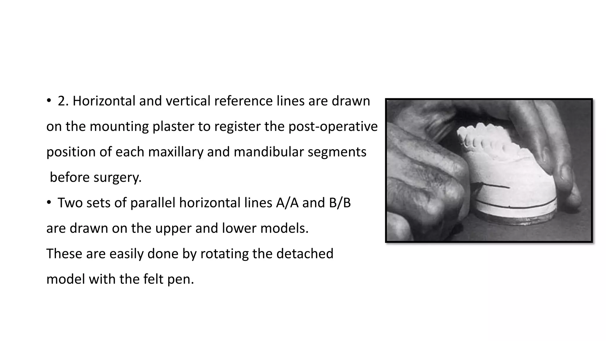 Preparation of surgical splints in bi jaw surgery | PPTX