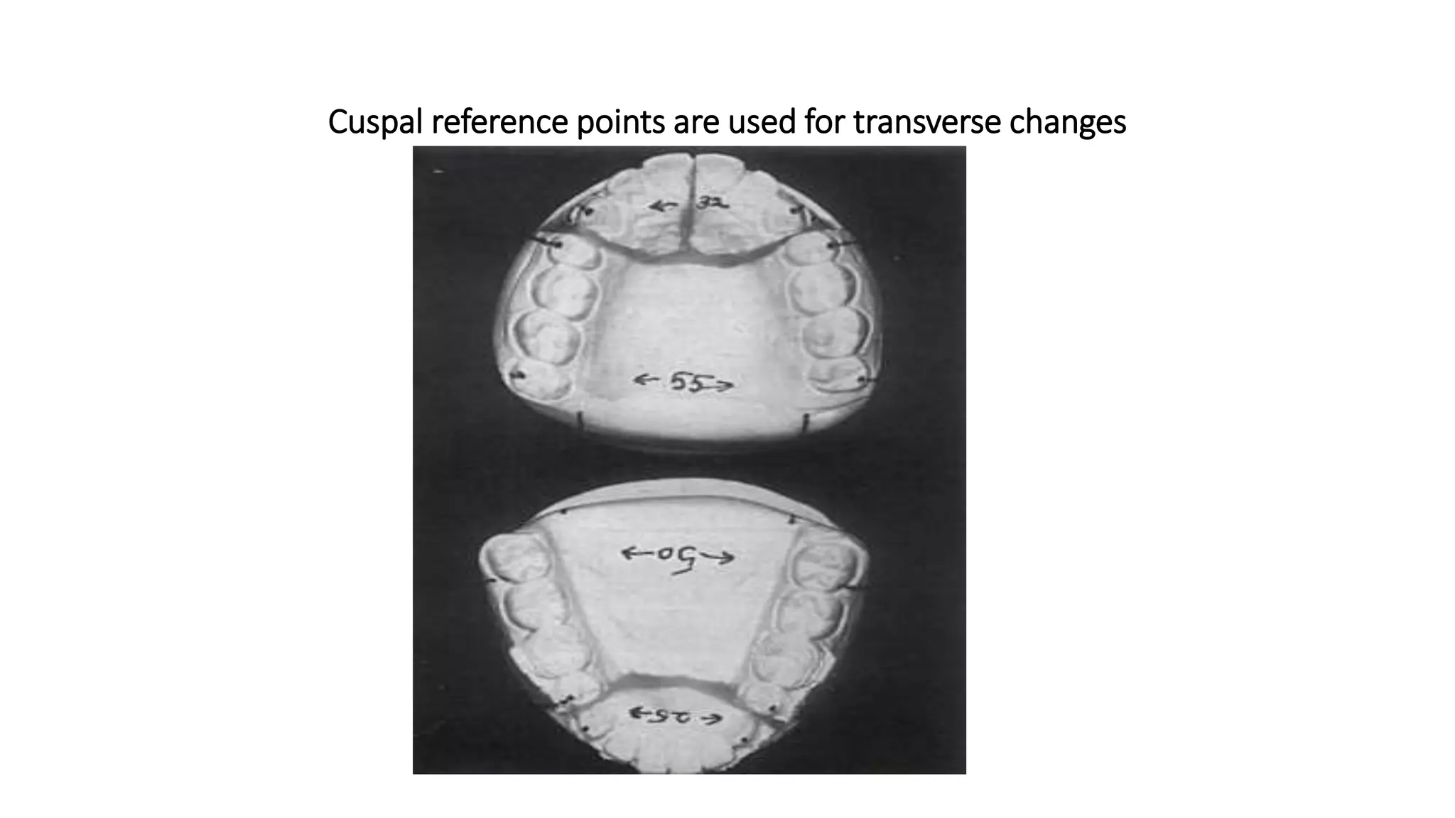 Preparation of surgical splints in bi jaw surgery | PPTX
