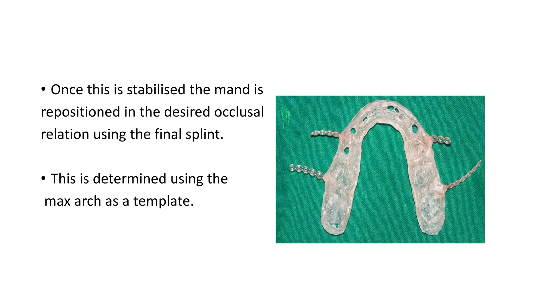 Preparation of surgical splints in bi jaw surgery | PPTX