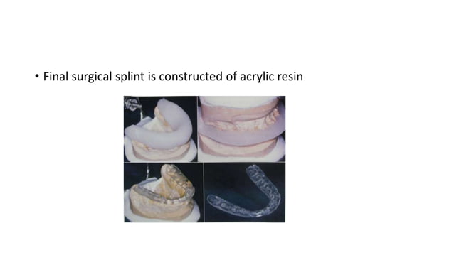 Preparation of surgical splints in bi jaw surgery | PPTX | Dental ...