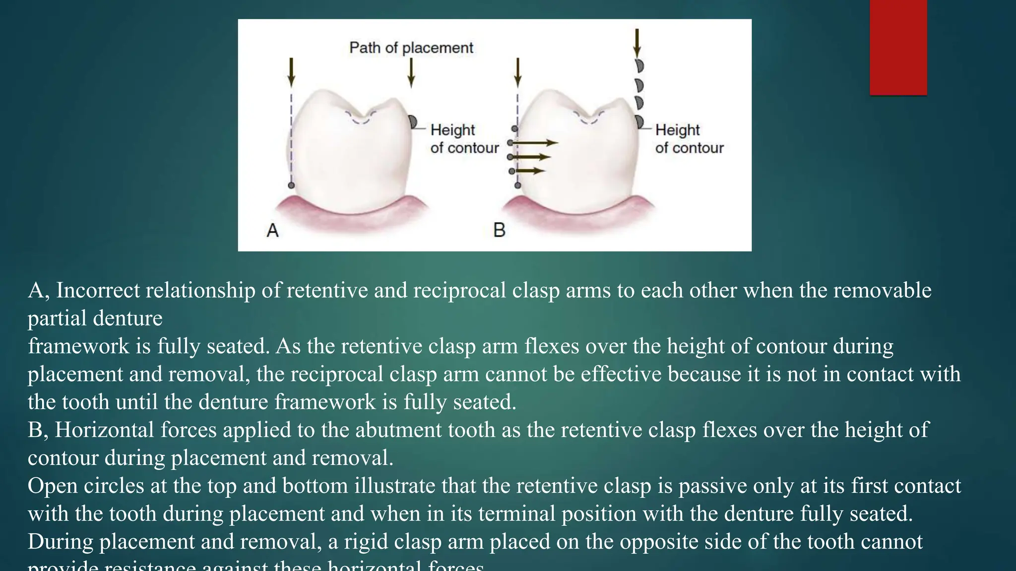 Preparation of the abutment teeth dd.pptx