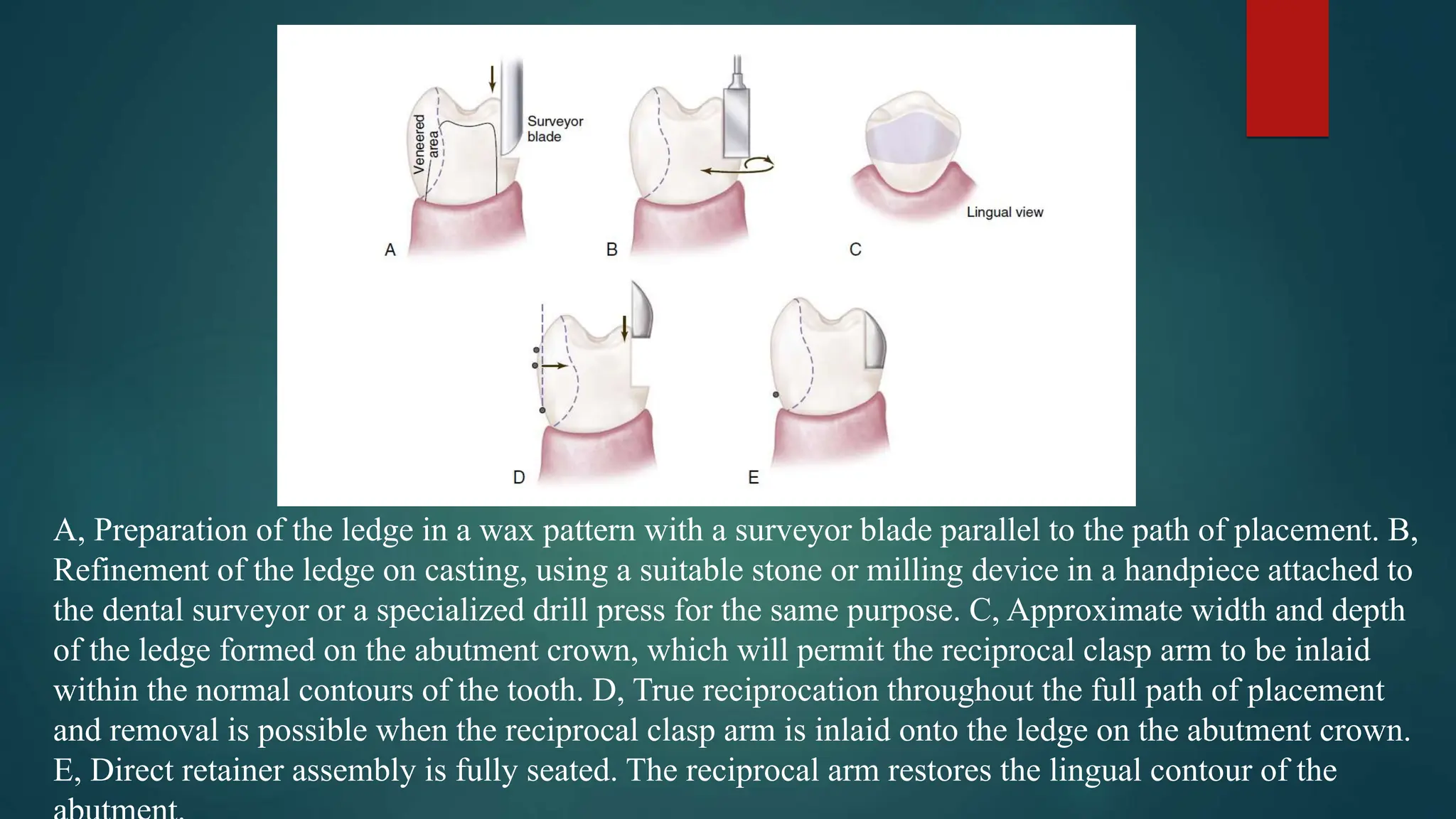Preparation of the abutment teeth dd.pptx