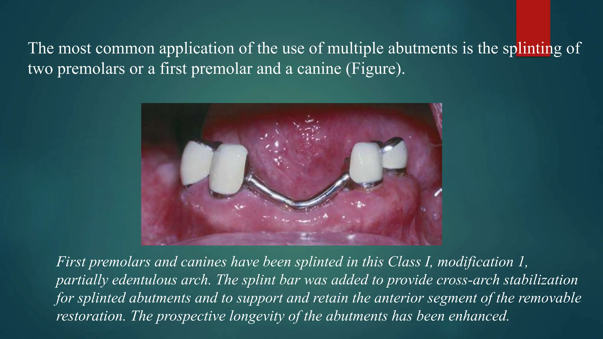 Preparation of the abutment teeth dd.pptx