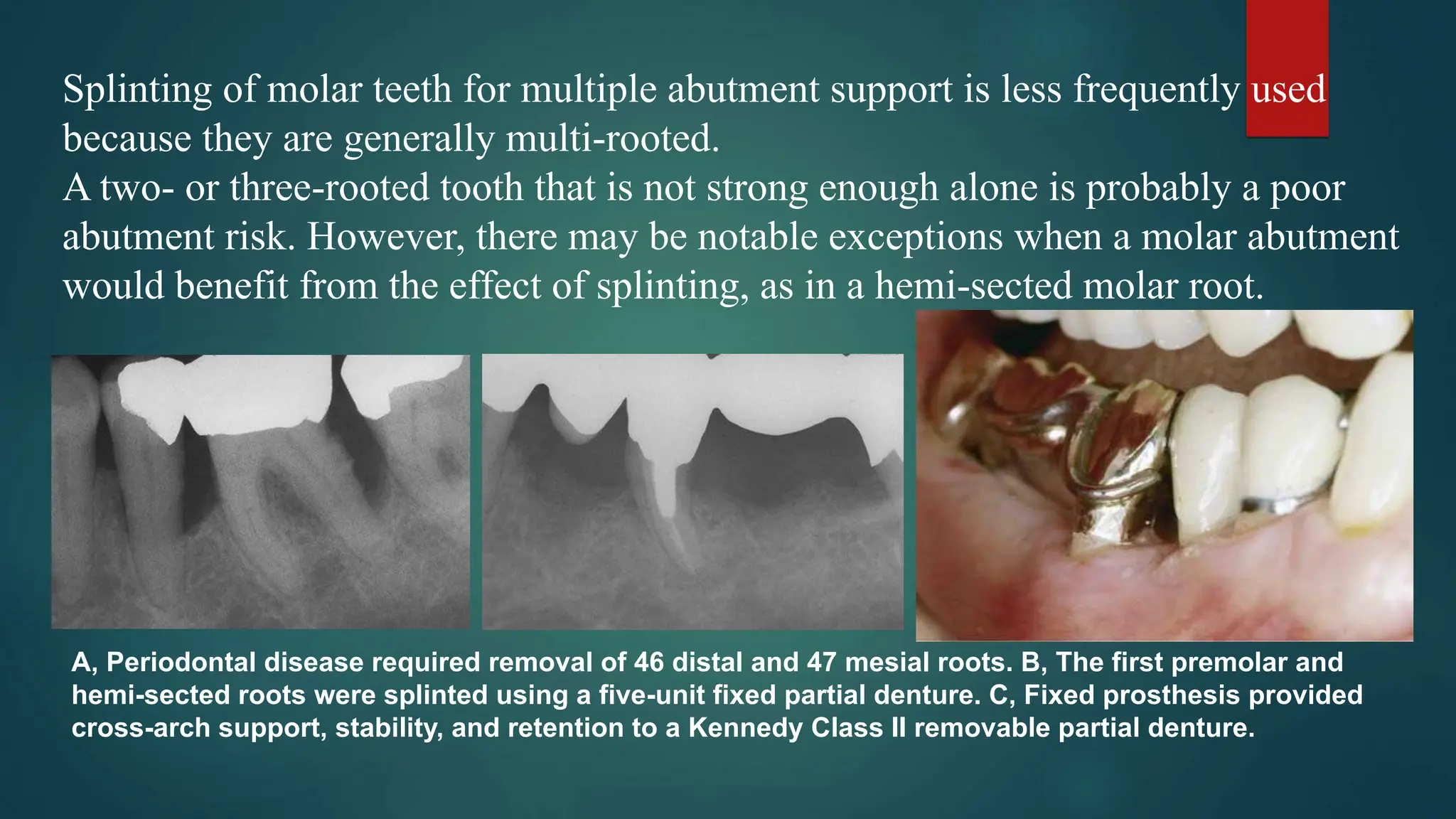 Preparation of the abutment teeth dd.pptx