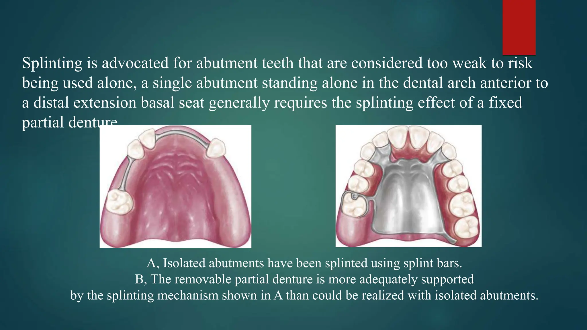 Preparation of the abutment teeth dd.pptx