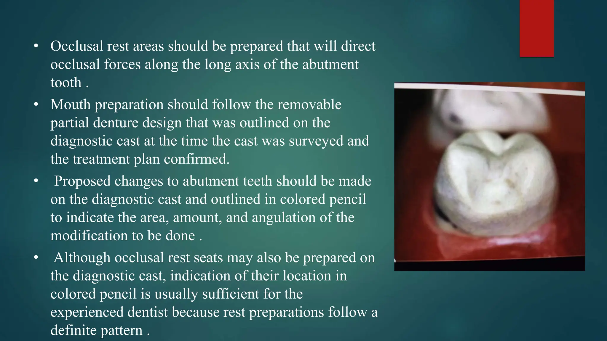 Preparation of the abutment teeth dd.pptx