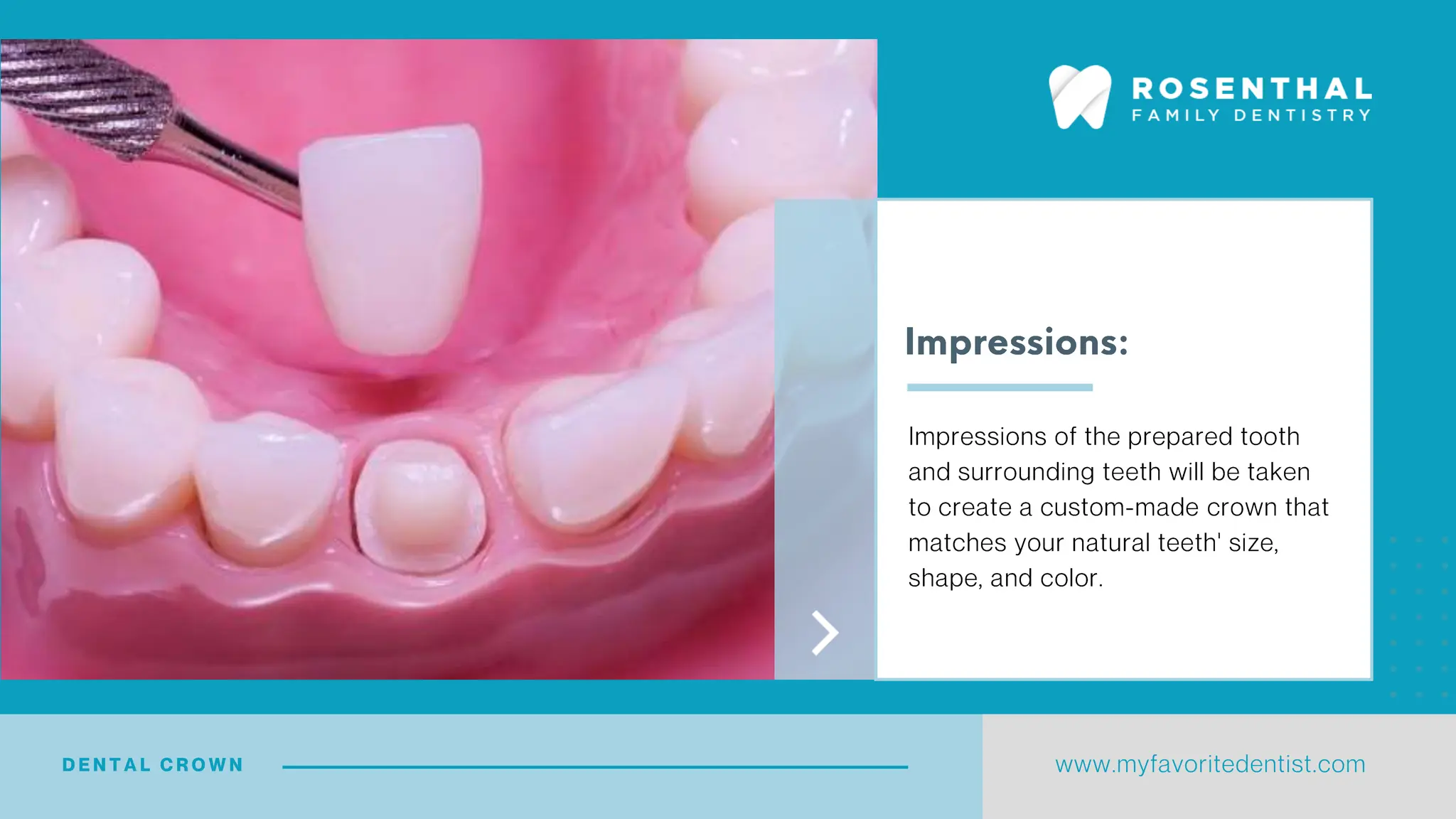 Preparing for a Dental Crown Procedure What to Expect.pptx