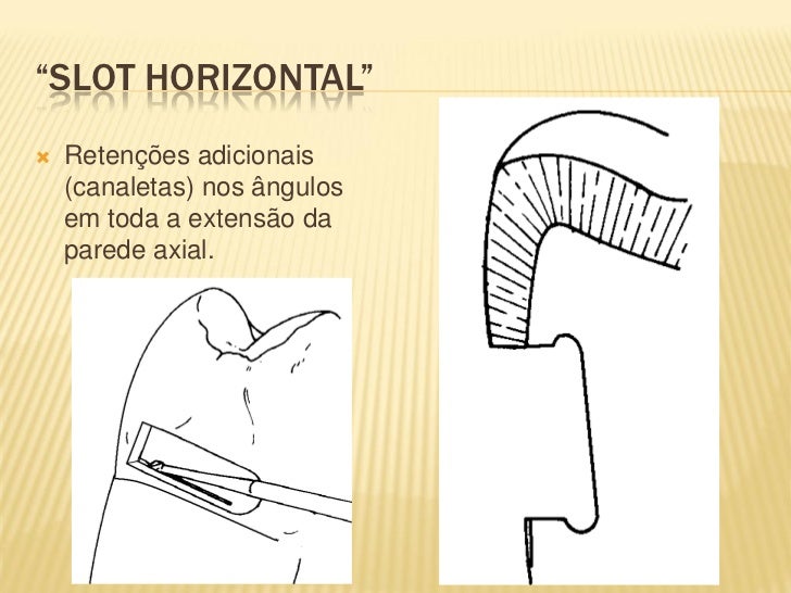 Preparo e restauração em amálgama 2012 1
