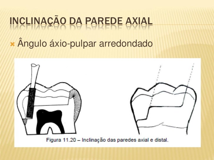 Preparo e restauração em amálgama 2012 1