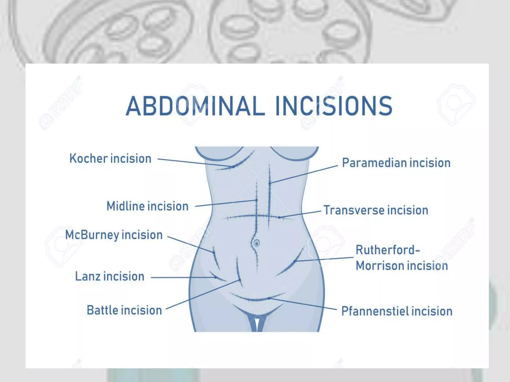 Pre & post operative physiotherapy in abdominal surgeries | PPTX