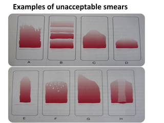 Prepration and staining of blood film | PPT