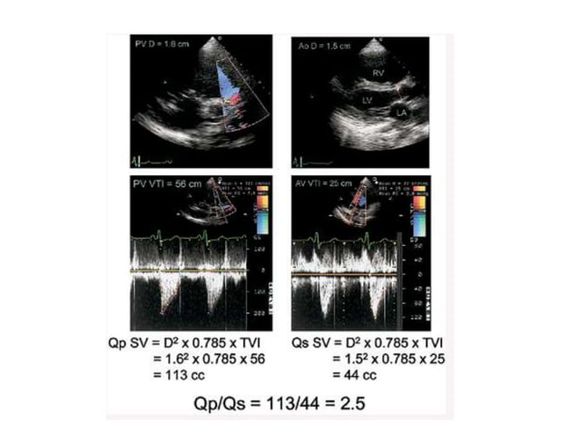 ECHO ASSESSMENT OF ASD FOR DEVICE CLOSURE | PPTX | 3-D Graphics ...