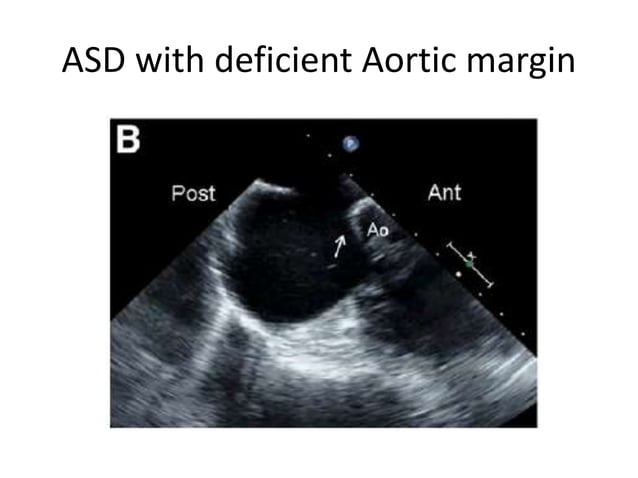 ECHO ASSESSMENT OF ASD FOR DEVICE CLOSURE | PPTX | 3-D Graphics ...