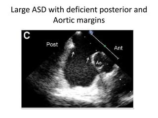 ECHO ASSESSMENT OF ASD FOR DEVICE CLOSURE | PPTX